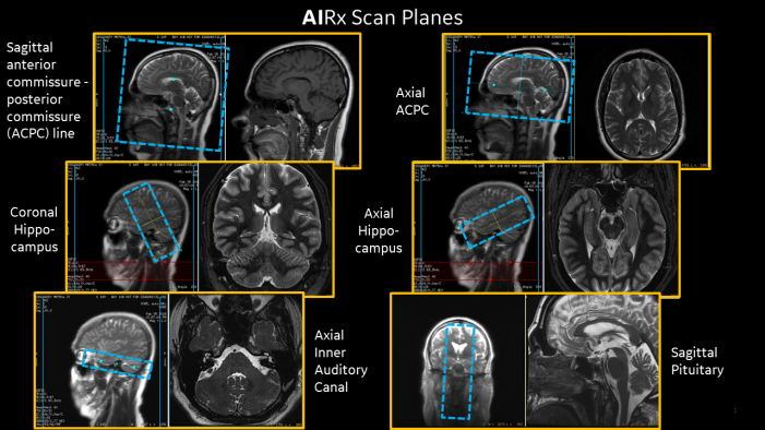 Intelligent Brain Mri